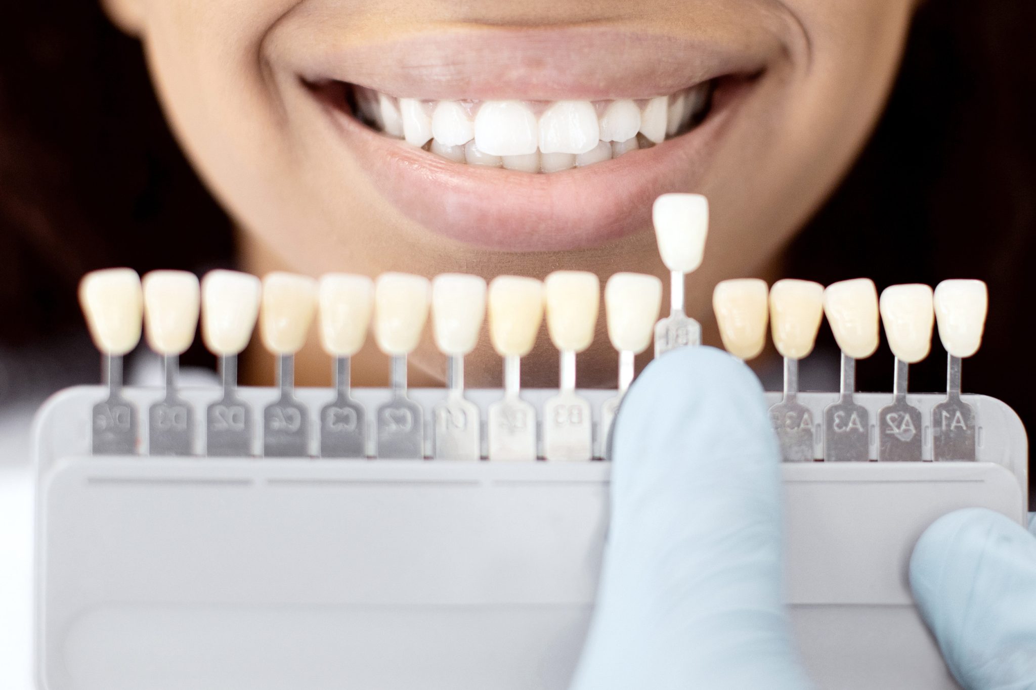 What Happens During a Veneers Procedure